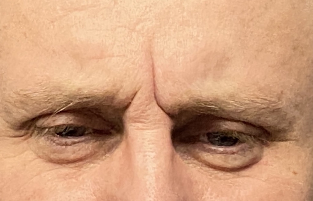 Technical Strategies - Treatment of the Deep Glabellar Furrow with ...