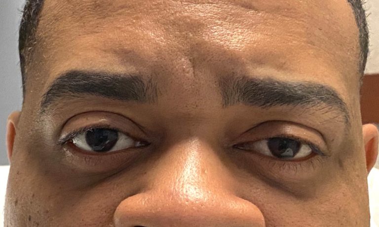 Plastic Surgery Case Study- Left Periorbital Asymmetry Correction with ...