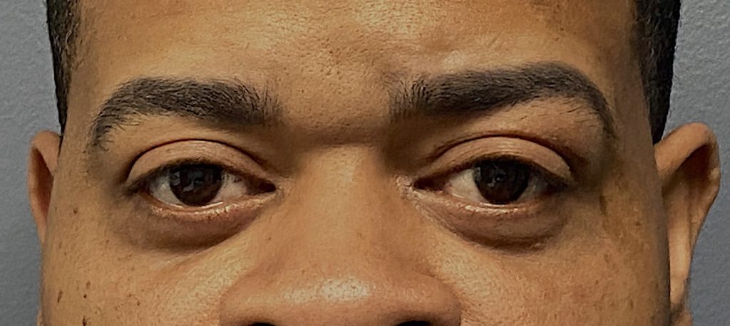 Plastic Surgery Case Study- Left Periorbital Asymmetry Correction with ...