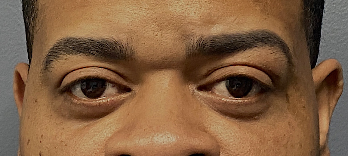 Plastic Surgery Case Study- Left Periorbital Asymmetry Correction with ...