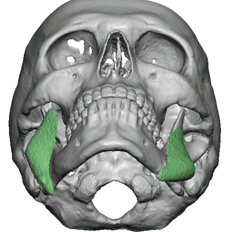 Plastic Surgery Case Study - Custom Jaw Angle Implant Replacements for ...