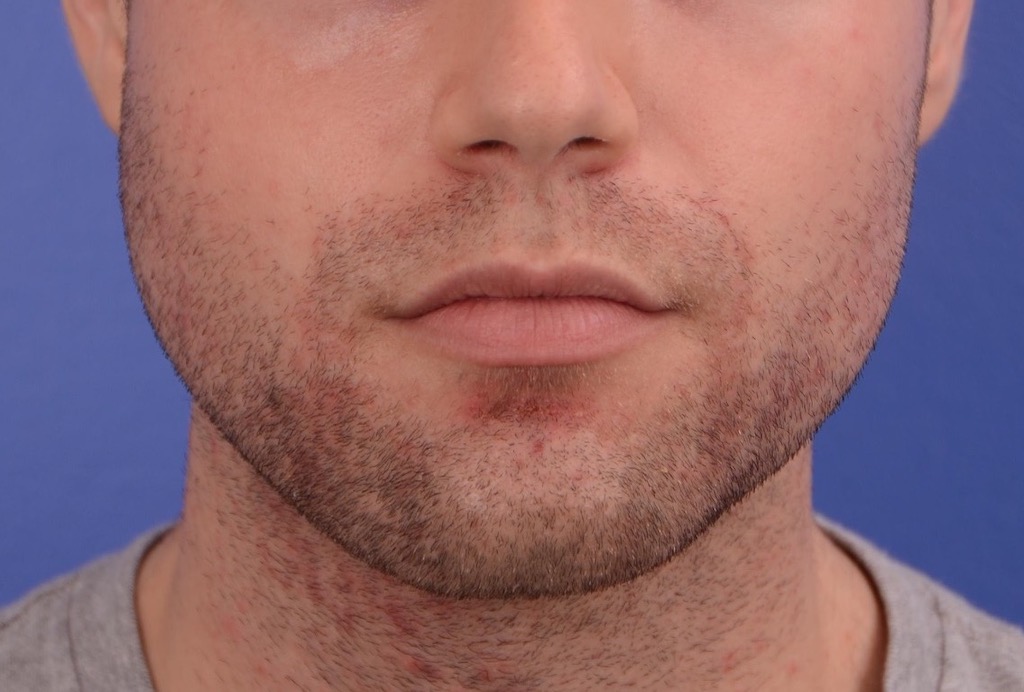 male malpositioned standard jaw angle implants front view Dr Barry ...