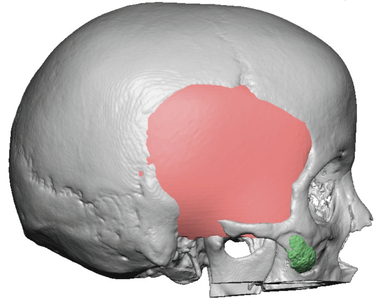 narrow head shape 3D CT scan side view Dr Barry Eppley - Explore ...