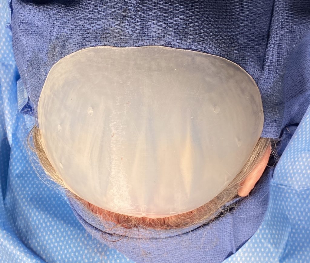 Plastic Surgery Case Study - Back of the Head Custom Skull Implant ...