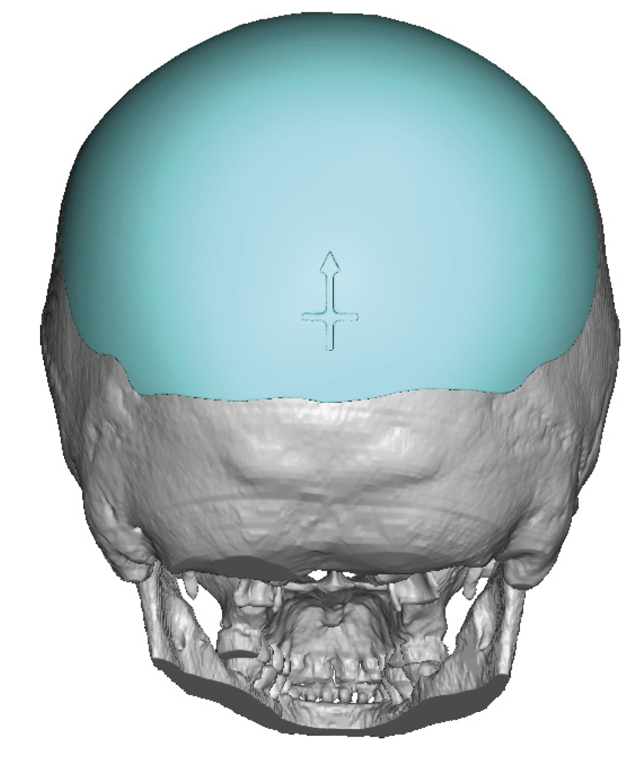 Plastic Surgery Case Study - Back of the Head Custom Skull Implant ...