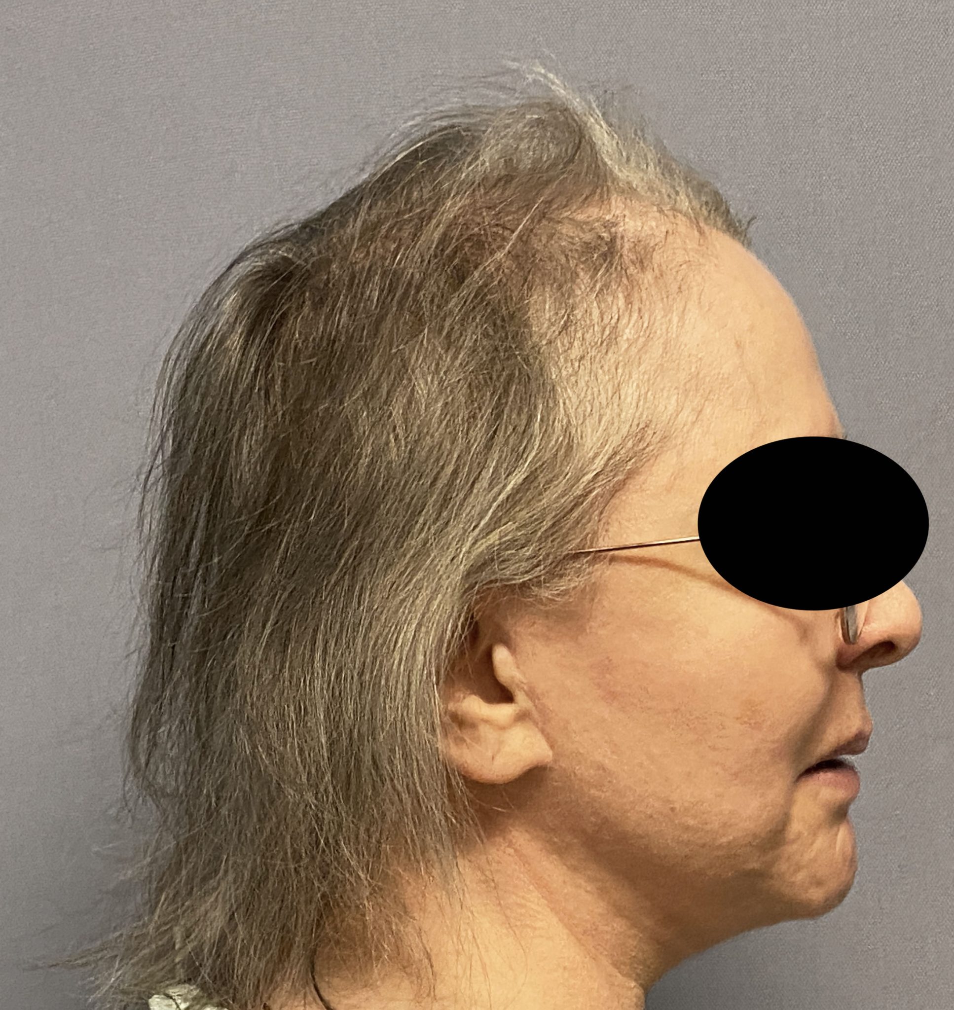 older female flat back of head side 1 Dr Barry Eppley copy - Explore ...