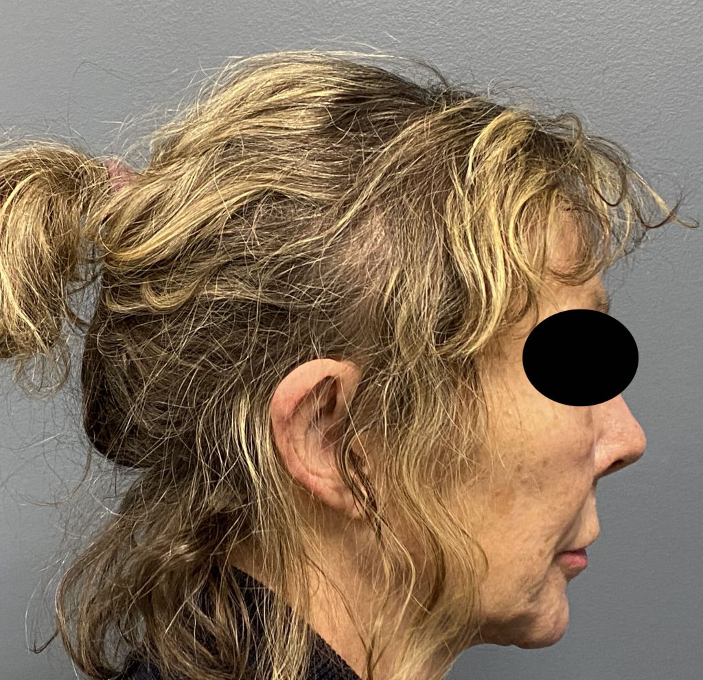 Plastic Surgery Case Study - Large Two Piece Surface Area Skull Implant ...