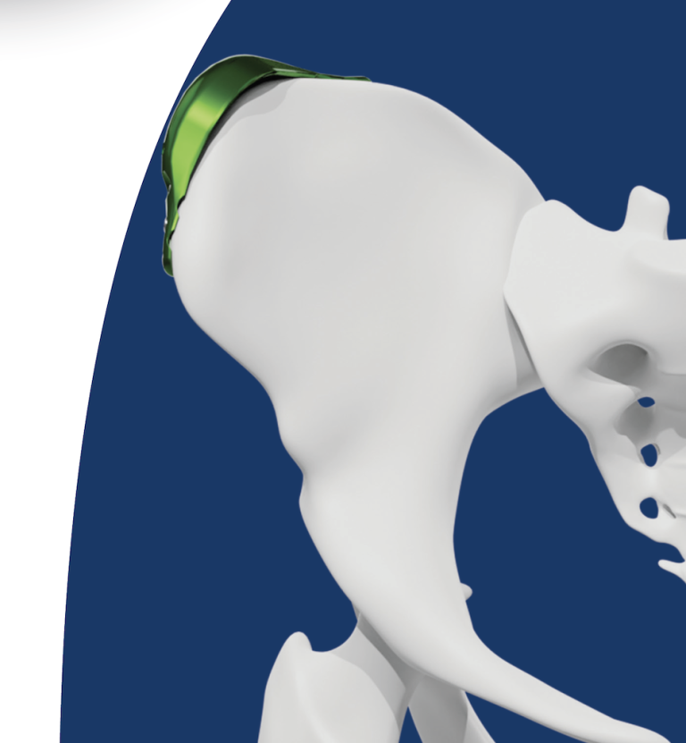 Pelvis Plasty for Upper Hip Widening - Iliac Crest Plate Design ...