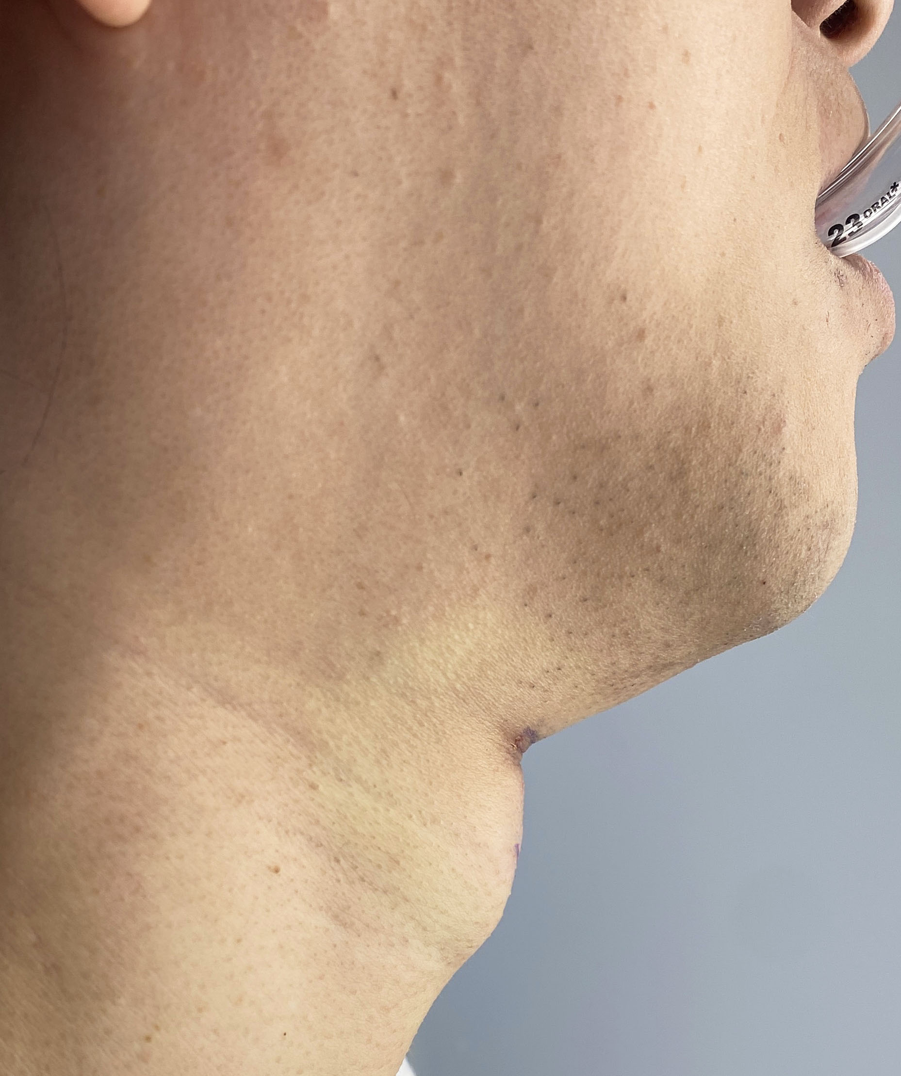 Plastic Surgery Case Study - Tracheal Shave Surgery in Asymmetric Adam ...