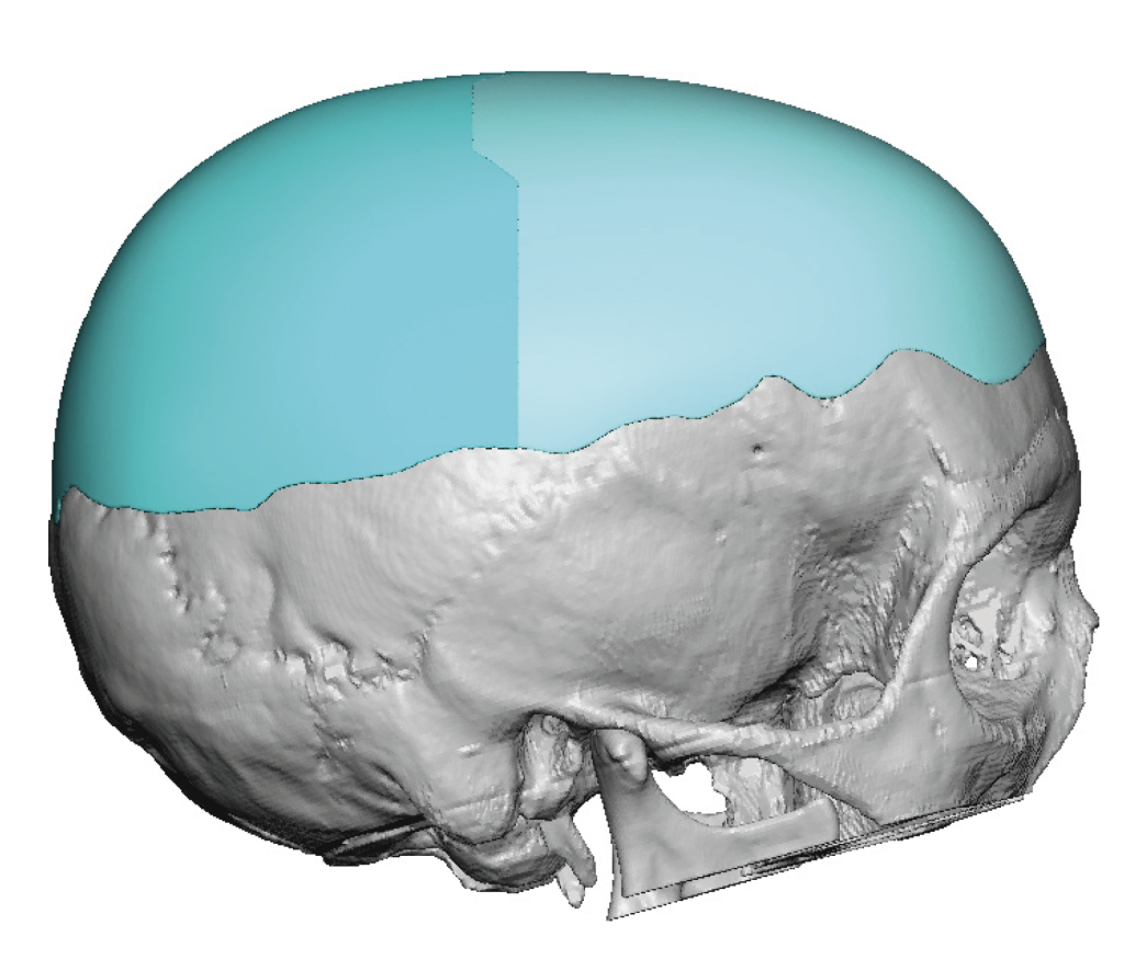 Plastic Surgery Case Study - Large Two Piece Surface Area Skull Implant ...