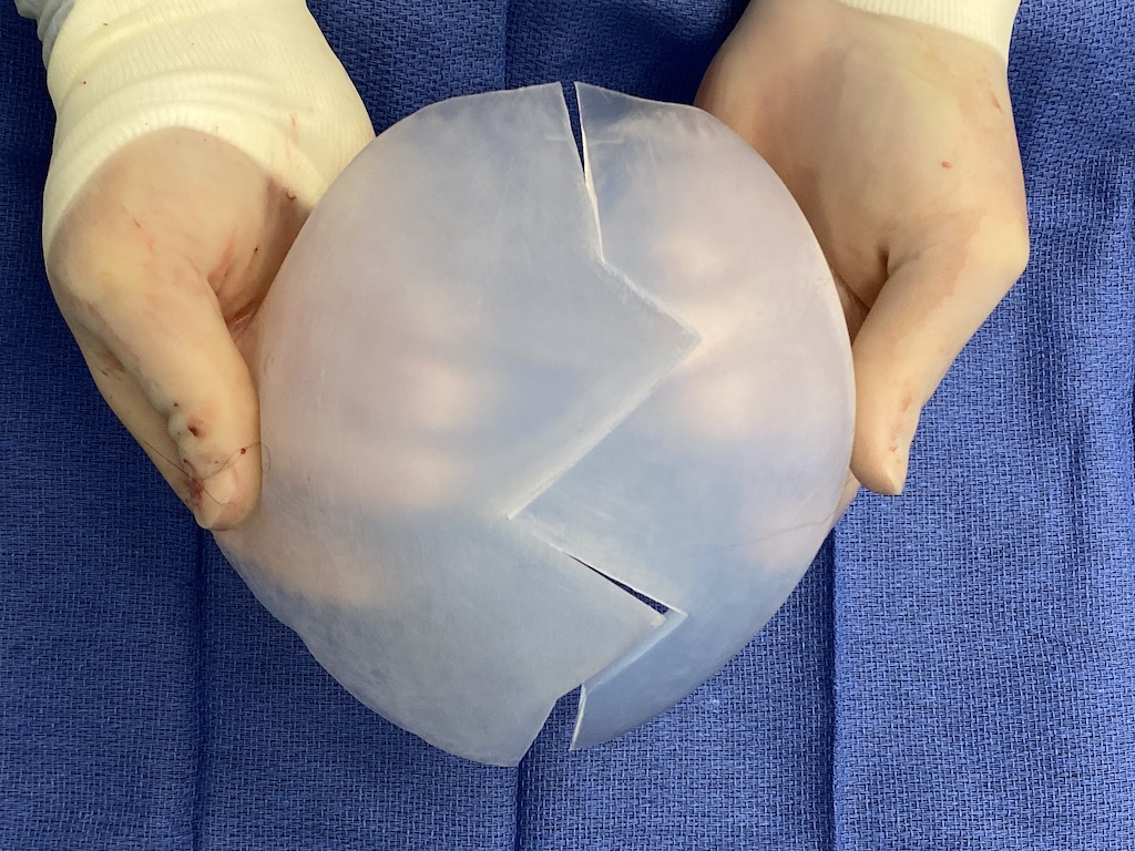 Plastic Surgery Case Study - Large Female Two Stage Skull Augmentation ...