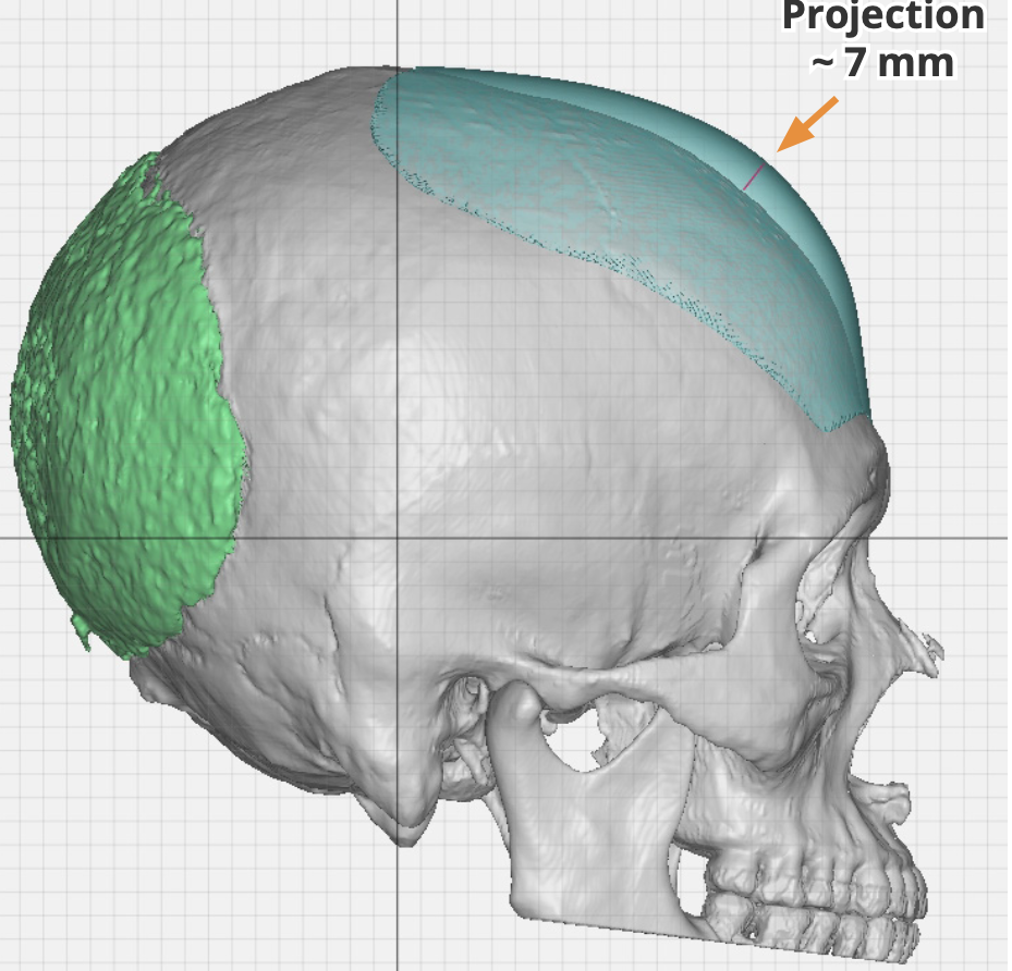 Plastic Surgery Case Study - Secondary Custom Forehead Implant for ...