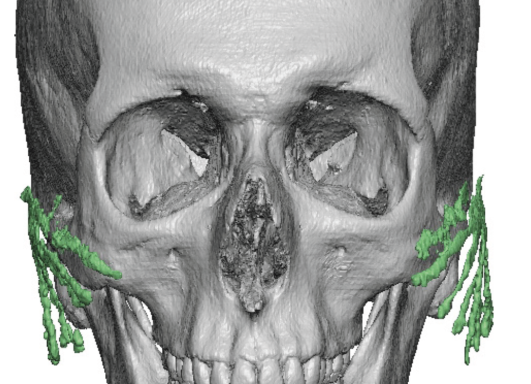 Plastic Surgery Case Study - Custom Infraorbital-Malar-Maxillary ...