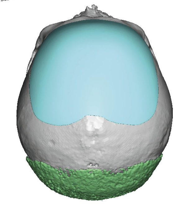 Plastic Surgery Case Study - Secondary Custom Forehead Implant for ...