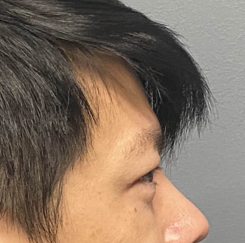 Plastic Surgery Case Study - Secondary Custom Forehead Implant for ...