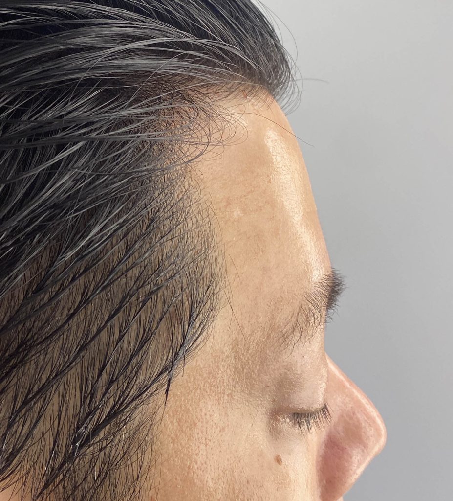 Plastic Surgery Case Study - Secondary Custom Forehead Implant for ...