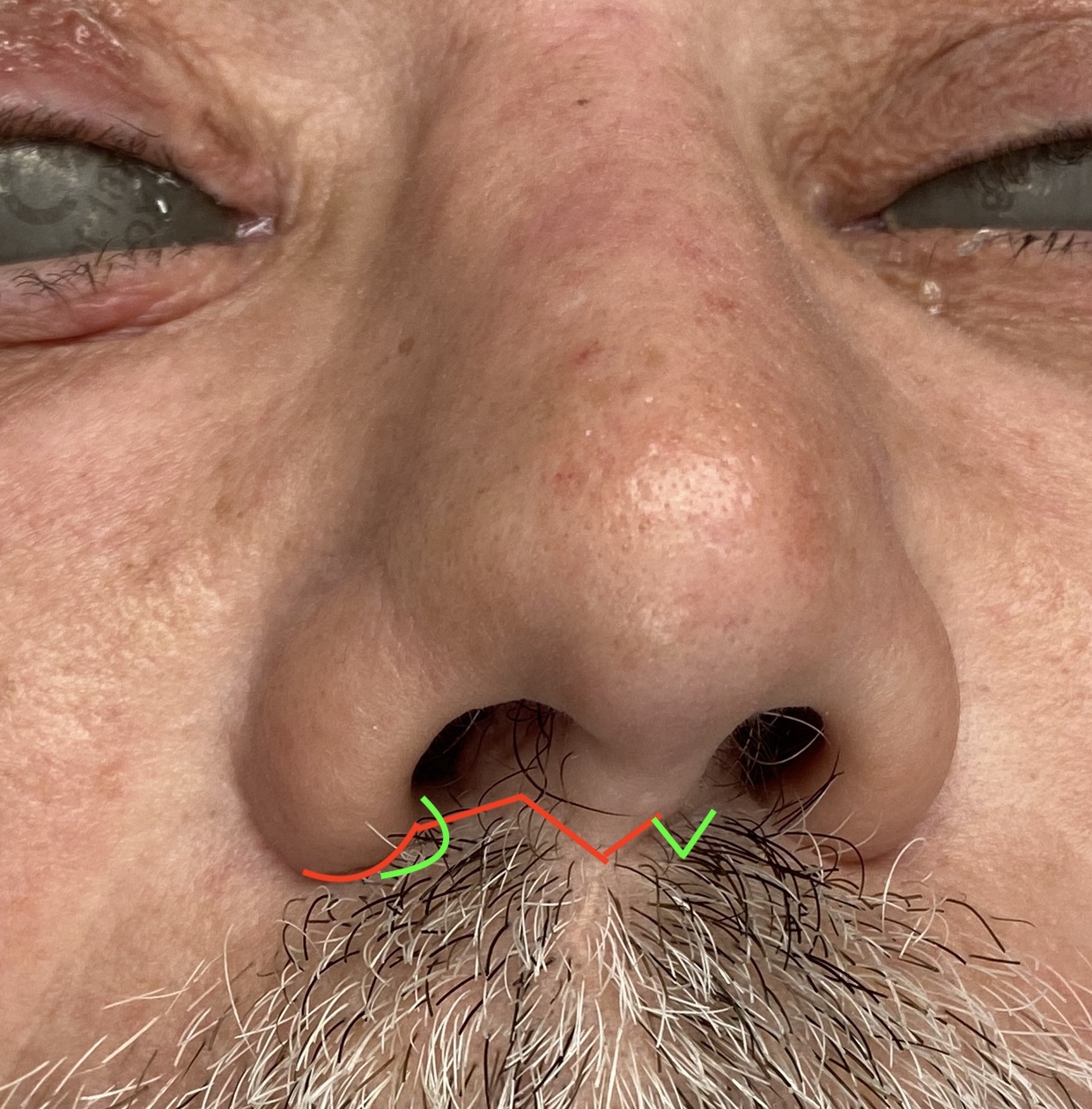 columellar- nostril repositioning incisions Dr Barry Eppley - Explore ...