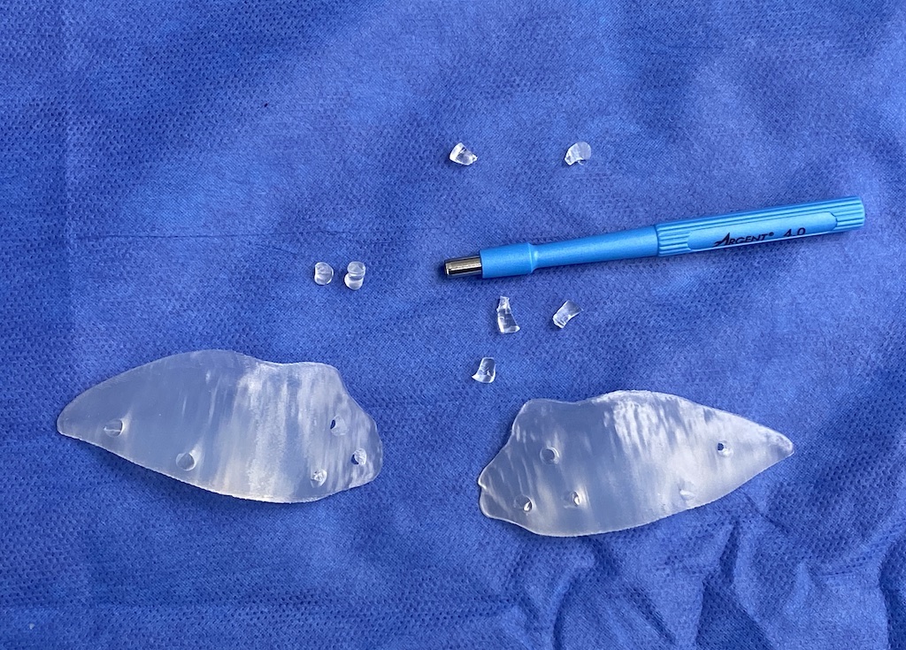 custom cheek implant perfusion hole placement Dr Barry Eppley - Explore ...