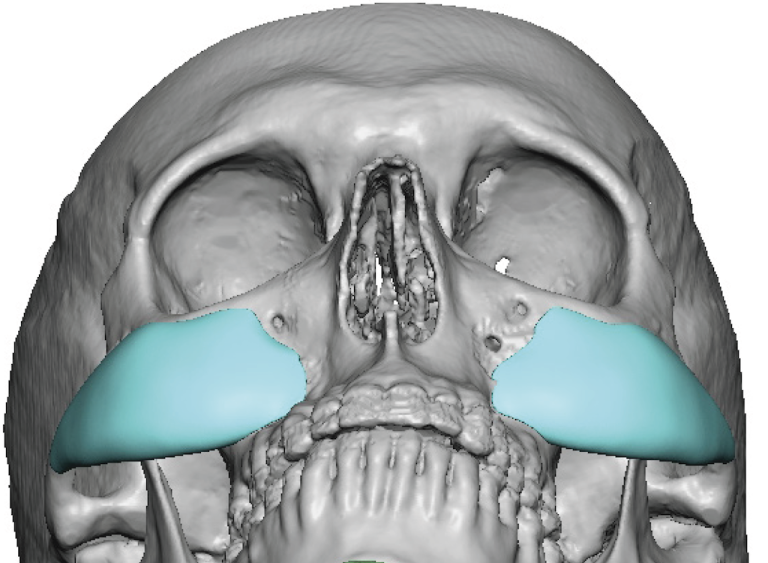 custom cheek implants design submental view Dr Barry Eppley - Explore ...