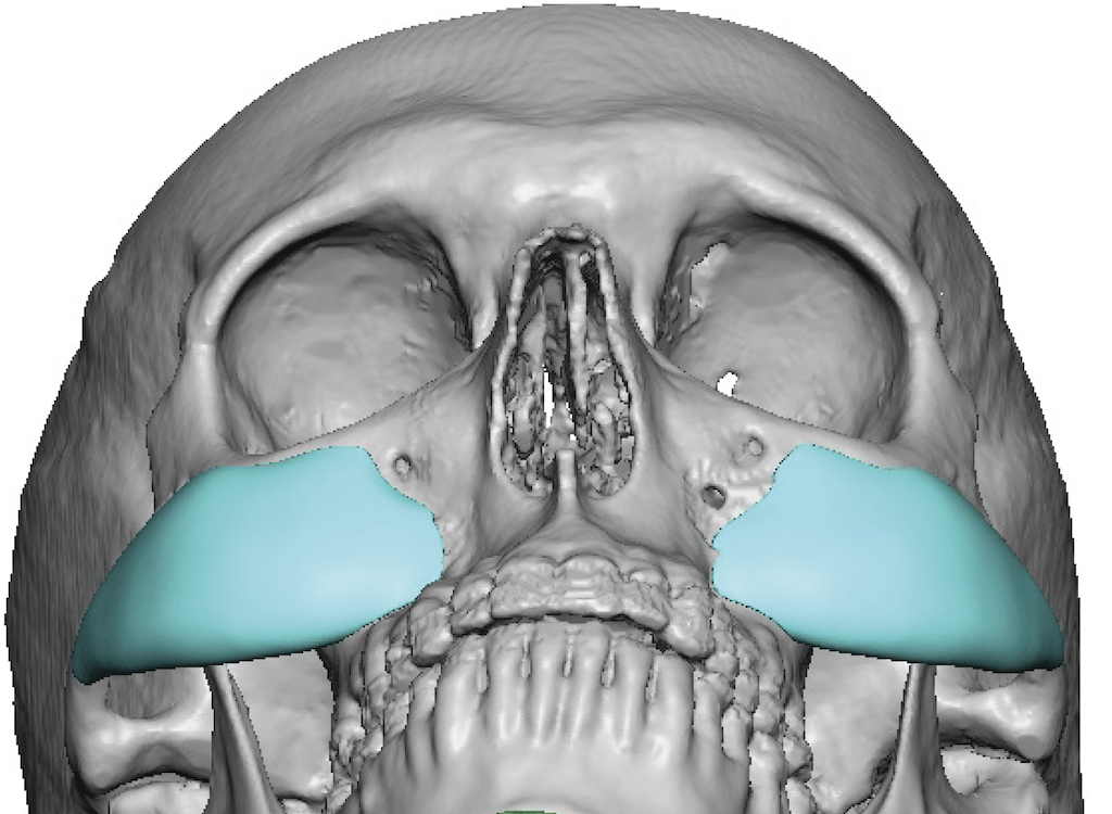 Plastic Surgery Case Study - Male Custom Large Submalar Cheek Implant ...