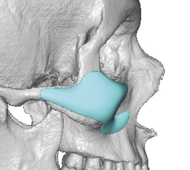 custom infraorbital-malar-maxilary implant design side view Dr Barry ...