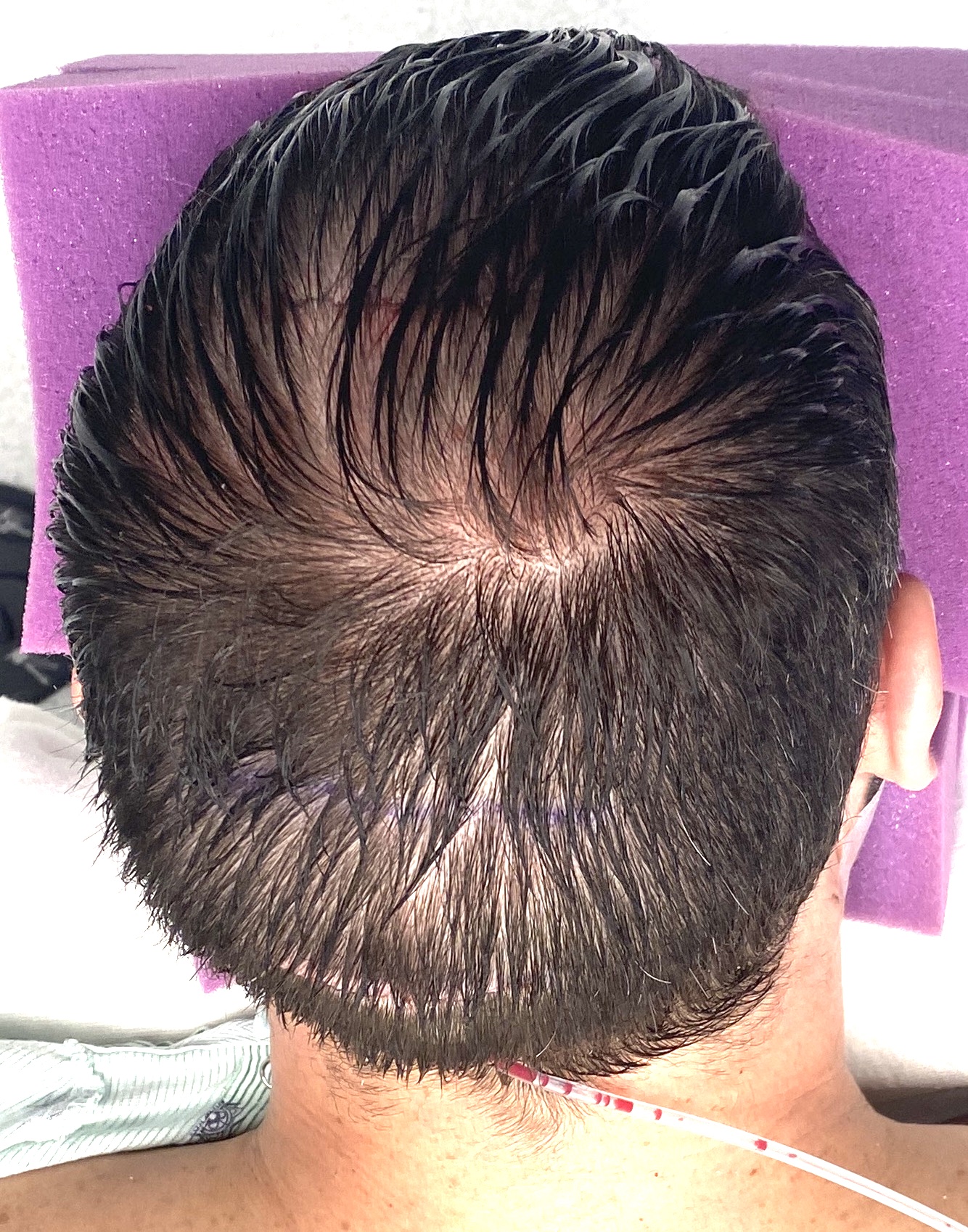 Plastic Surgery Case Study - Multi-Surface Skull Reductions of Sagittal ...