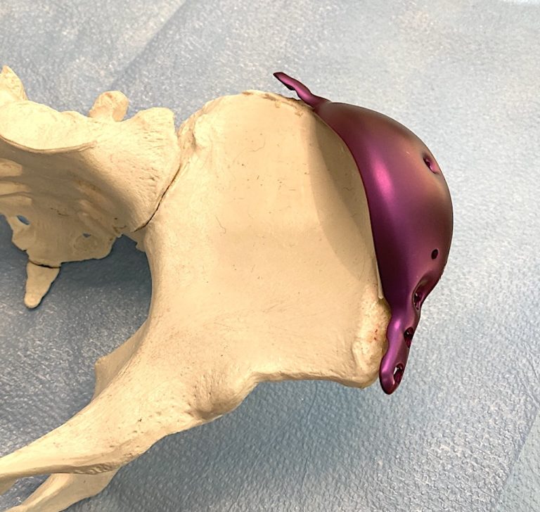 Pelvic Plasty - Iliac Crest Plate Widths - Explore Plastic Surgery