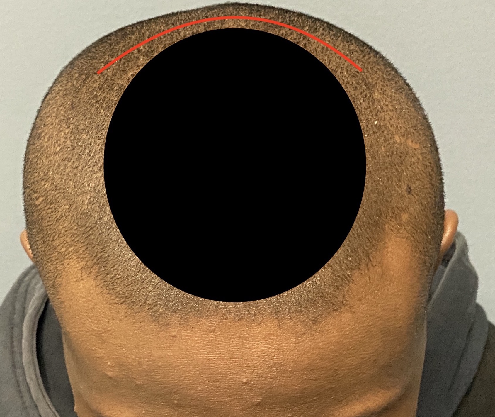 Plastic Surgery Case Study - Multi Surface Head Reshaping with a Custom ...