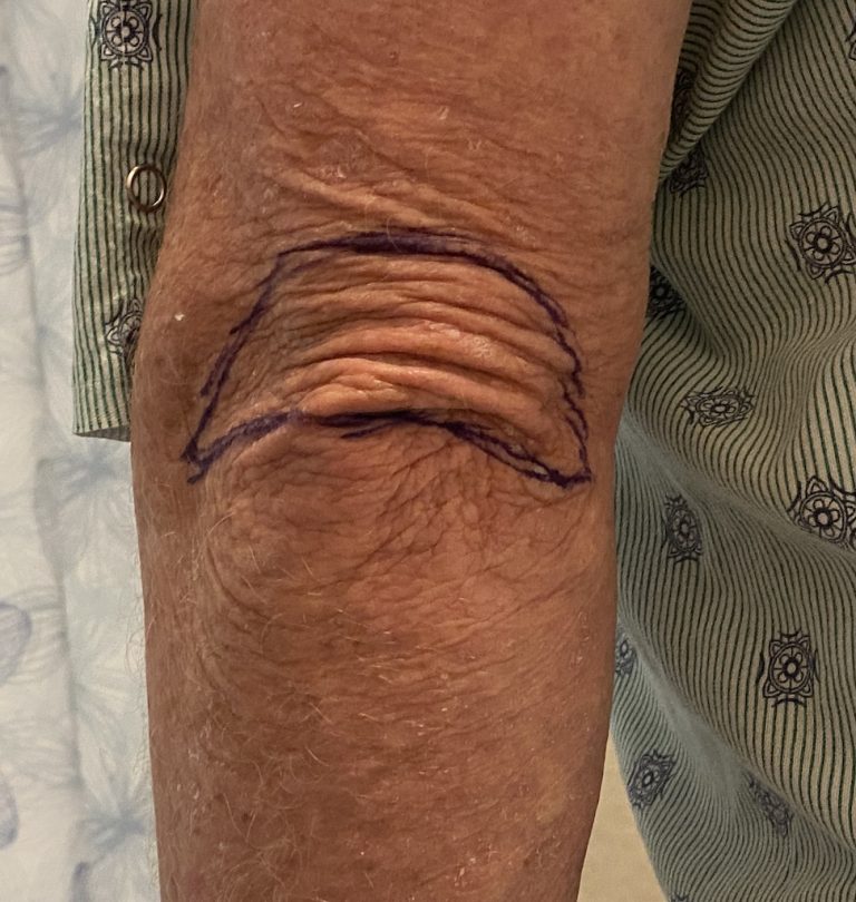 Plastic Surgery Case Study - Male Elbow Lifts for Excessive Skin Folds ...