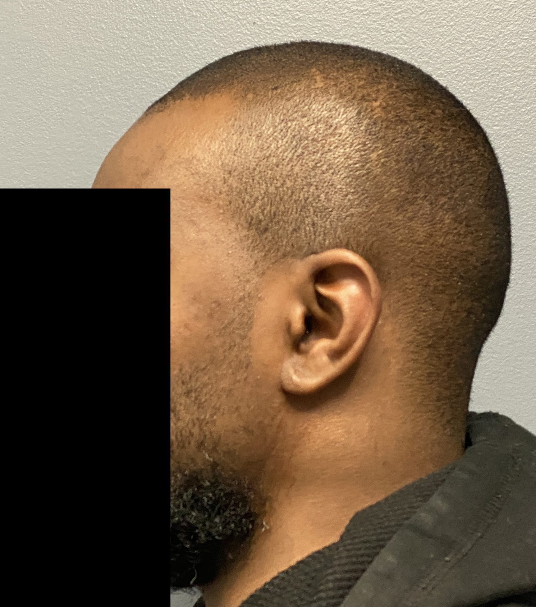 Plastic Surgery Case Study - Multi Surface Head Reshaping with a Custom ...