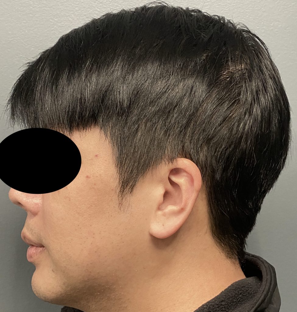 Plastic Surgery Case Study - Ten Year Outcome Of A Custom HTR Skull ...