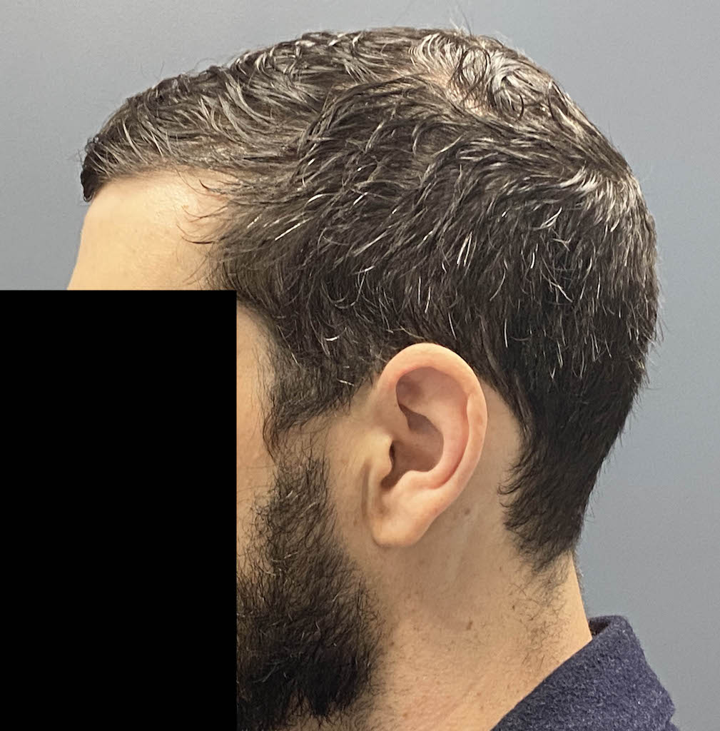 Plastic Surgery Case Study - Multi-Surface Skull Reductions of Sagittal ...