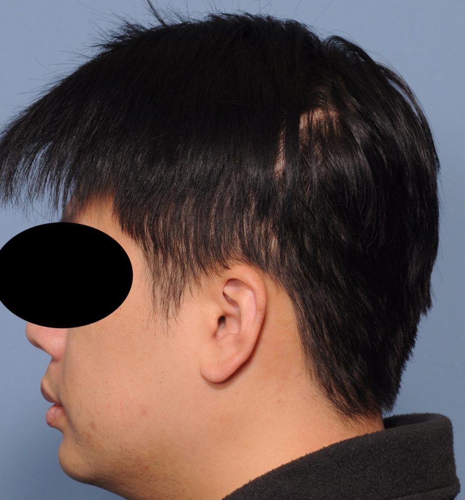 Plastic Surgery Case Study - Ten Year Outcome Of A Custom HTR Skull ...