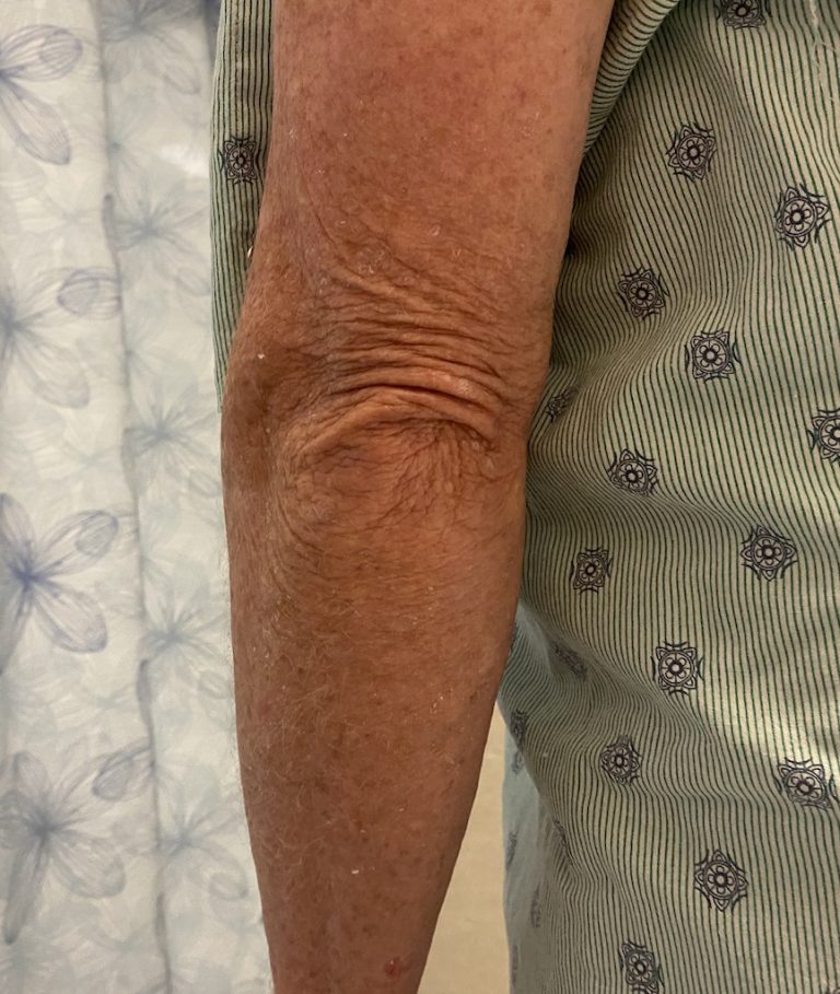 Plastic Surgery Case Study - Male Elbow Lifts for Excessive Skin Folds ...