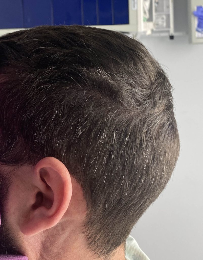 Plastic Surgery Case Study - Multi-Surface Skull Reductions of Sagittal ...