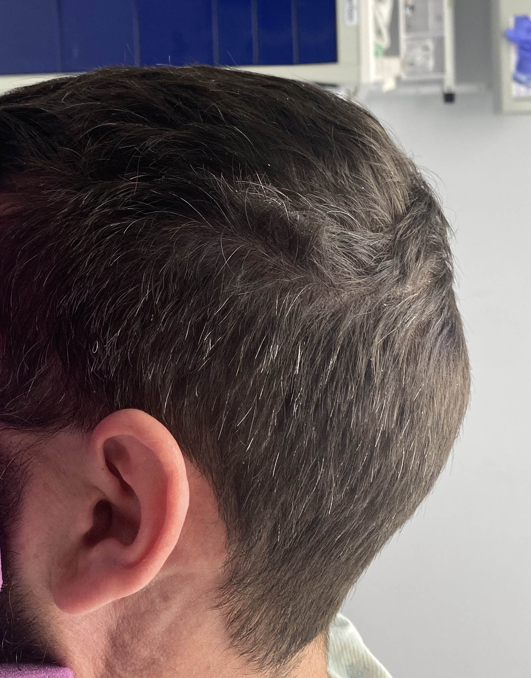 Plastic Surgery Case Study - Multi-Surface Skull Reductions of Sagittal ...