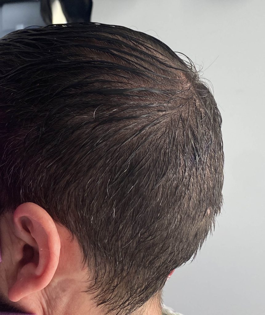 Plastic Surgery Case Study - Multi-Surface Skull Reductions of Sagittal ...