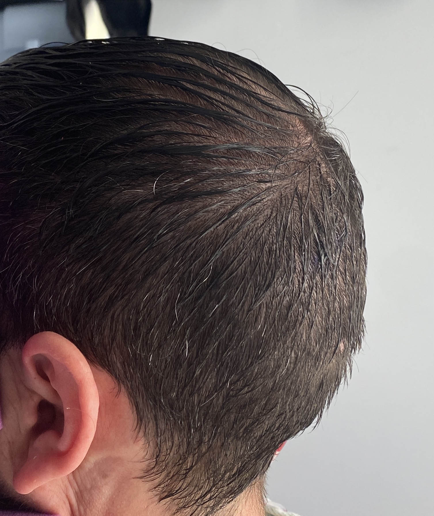 Plastic Surgery Case Study - Multi-Surface Skull Reductions of Sagittal ...