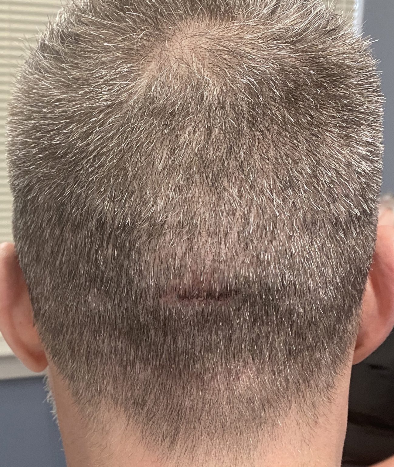 Plastic Surgery Case Study - Minimal Incision Occipital Knob Skull ...