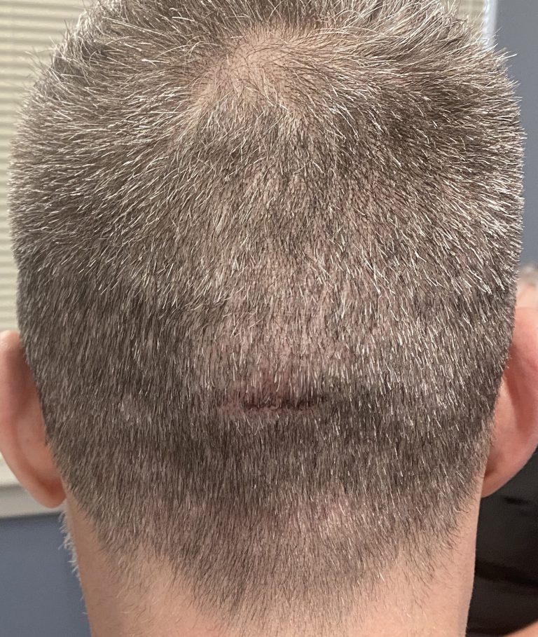 Plastic Surgery Case Study - Minimal Incision Occipital Knob Skull ...