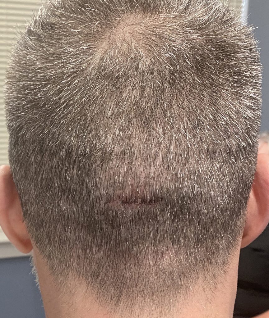 occipital knob skull reduction abck 2 Dr Barry Eppley - Explore Plastic ...