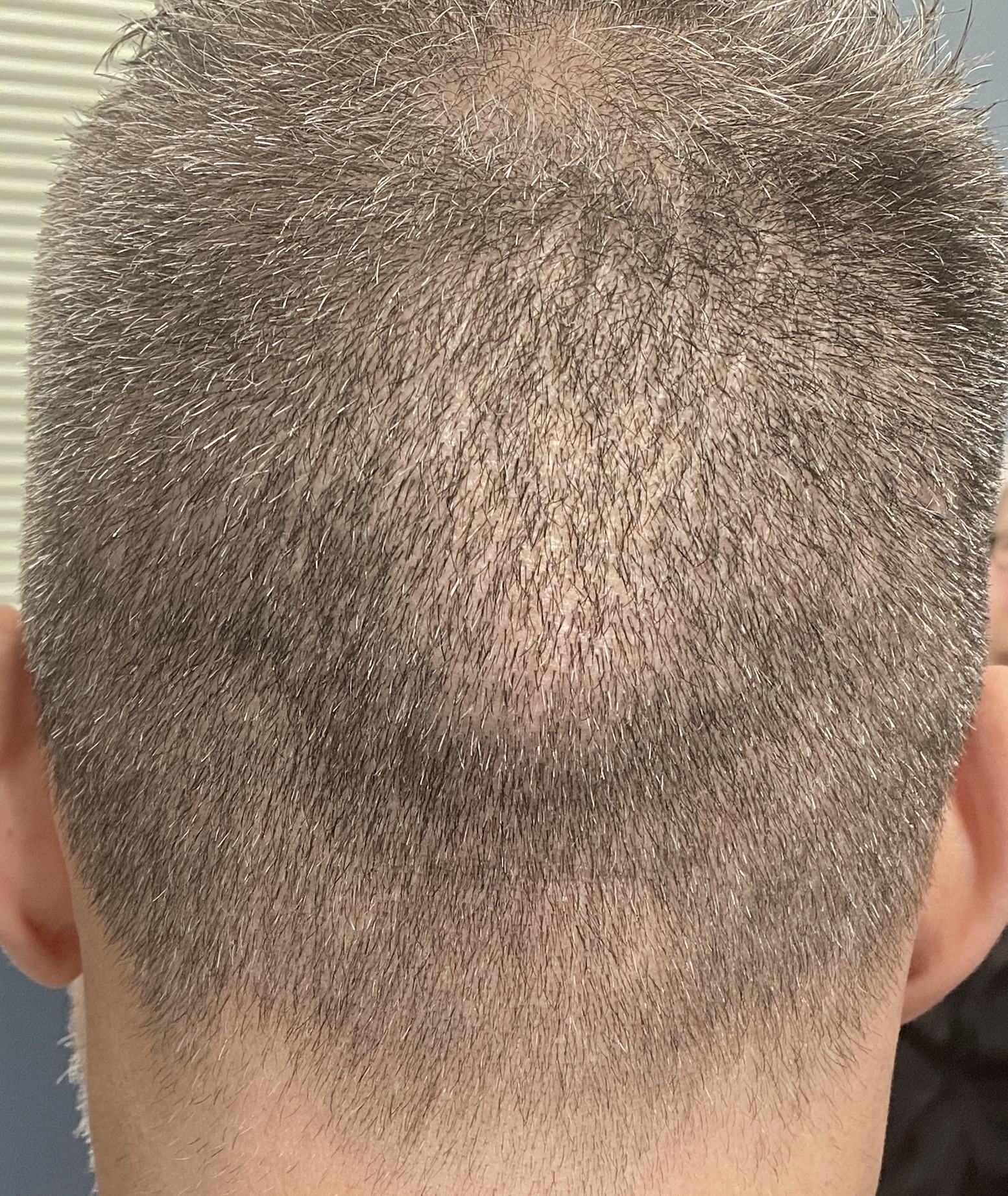 Plastic Surgery Case Study - Minimal Incision Occipital Knob Skull ...