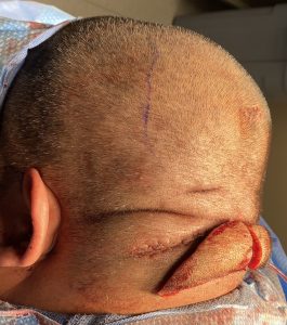 occipital scalp roll excision side view Dr Barry Eppley - Explore ...