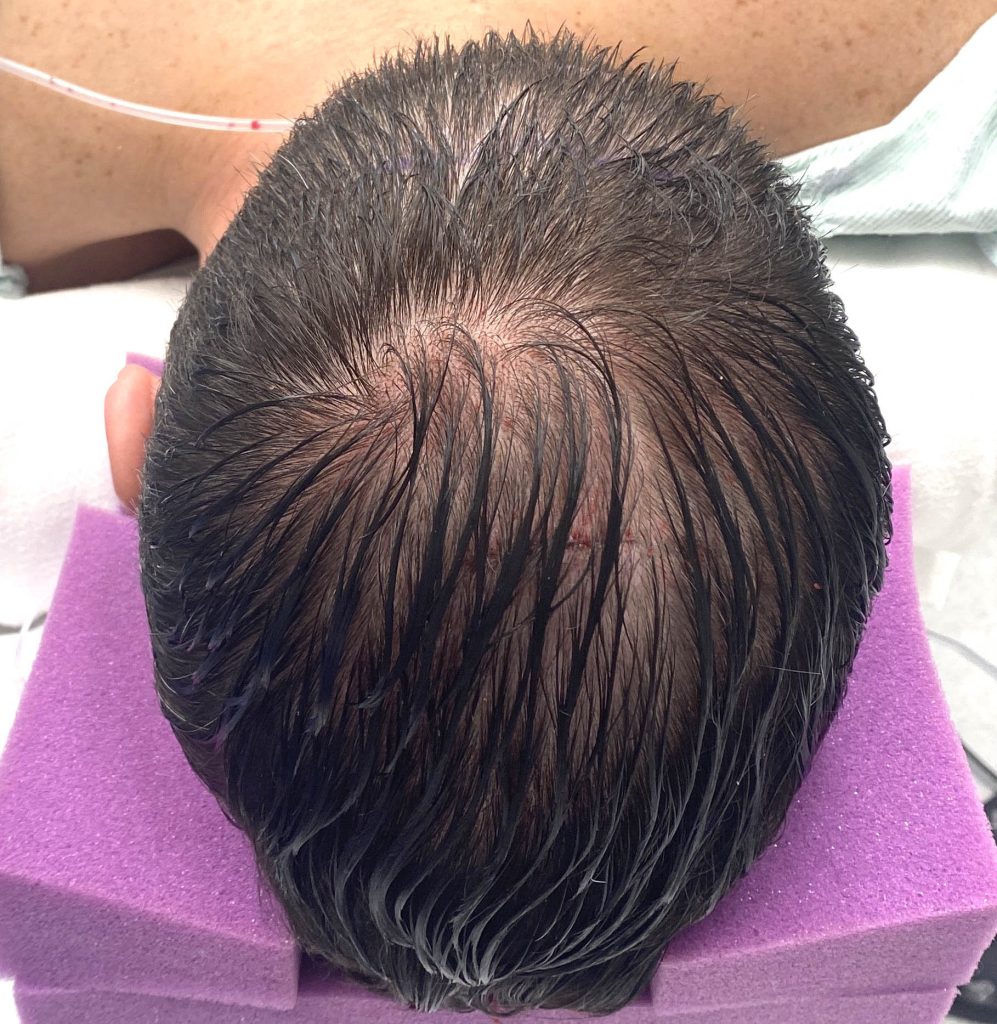 Plastic Surgery Case Study - Multi-Surface Skull Reductions of Sagittal ...