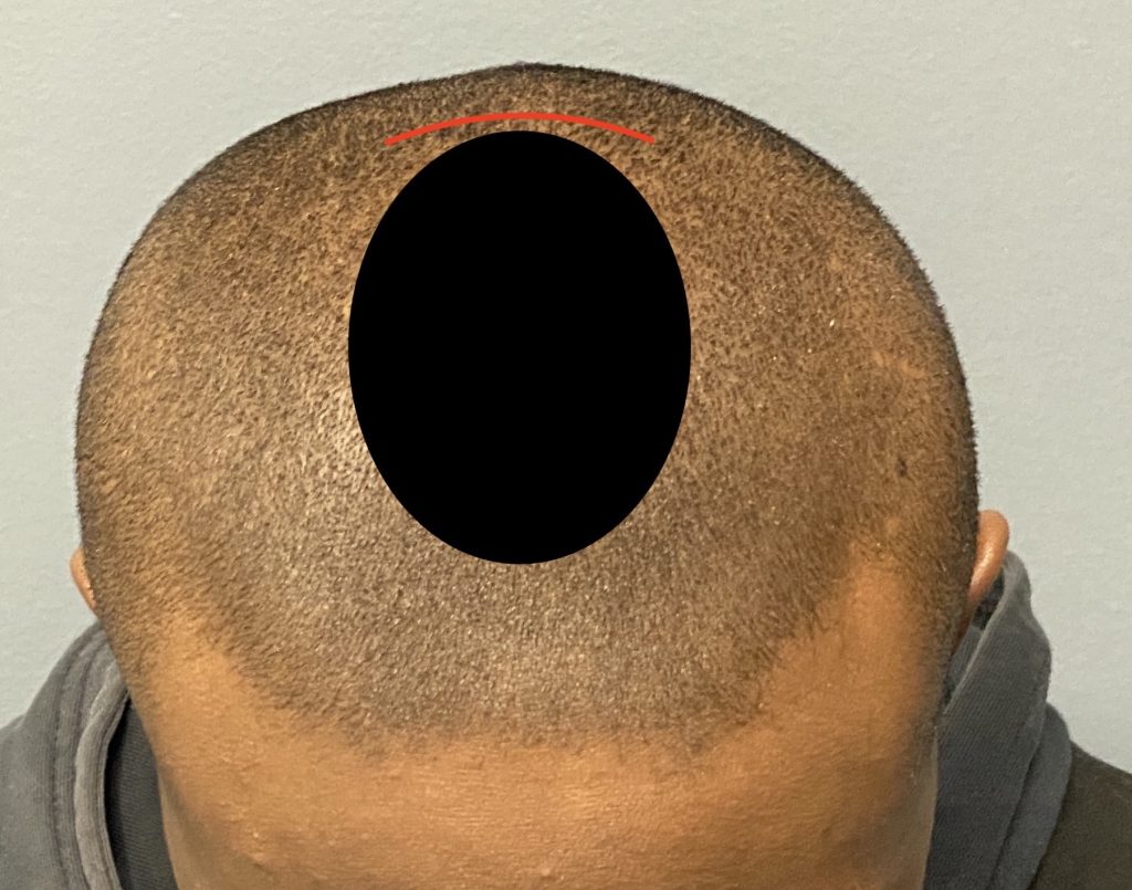 Plastic Surgery Case Study - Multi Surface Head Reshaping with a Custom ...