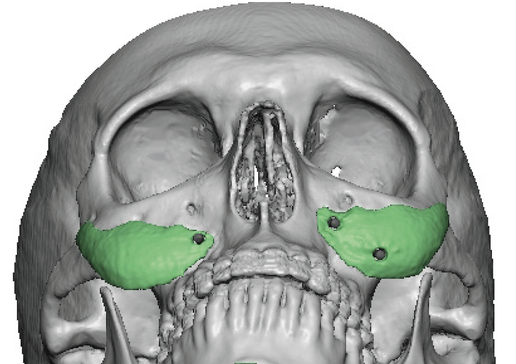 standard cheek implants 3D CT scan submental view Dr Barry Eppley ...