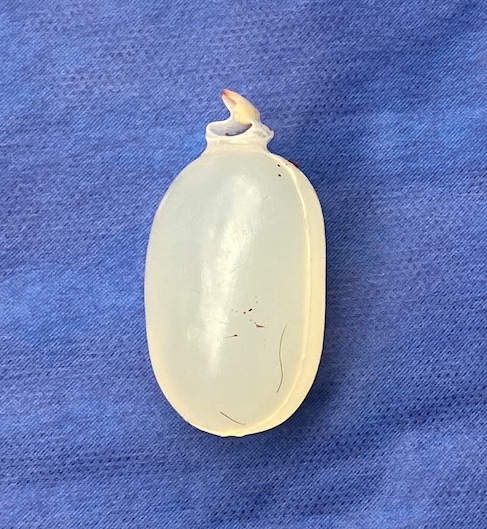 Plastic Surgery Case Study - Custom Left Testicle Implant Replacement ...