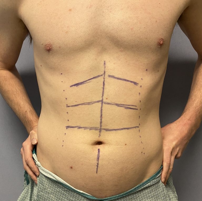 Liposuction Archives Explore Plastic Surgery