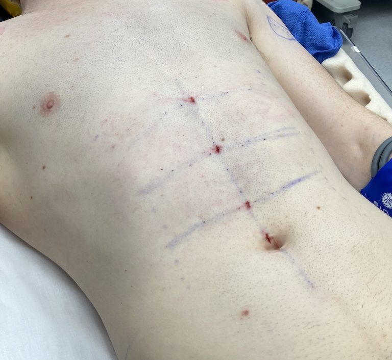 abdominal etching incisions oblique view Dr Barry Eppley - Explore ...