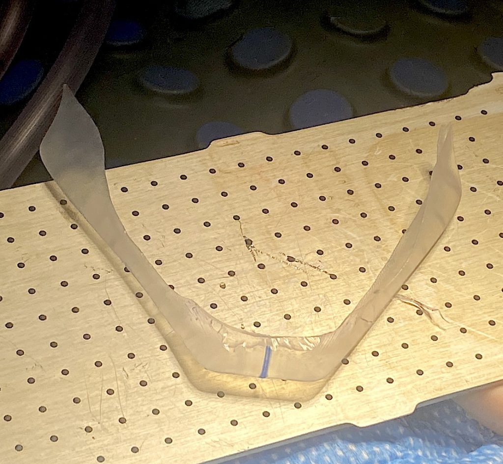 chin implamt inset made into jawline implant Dr Barry Eppley - Explore ...